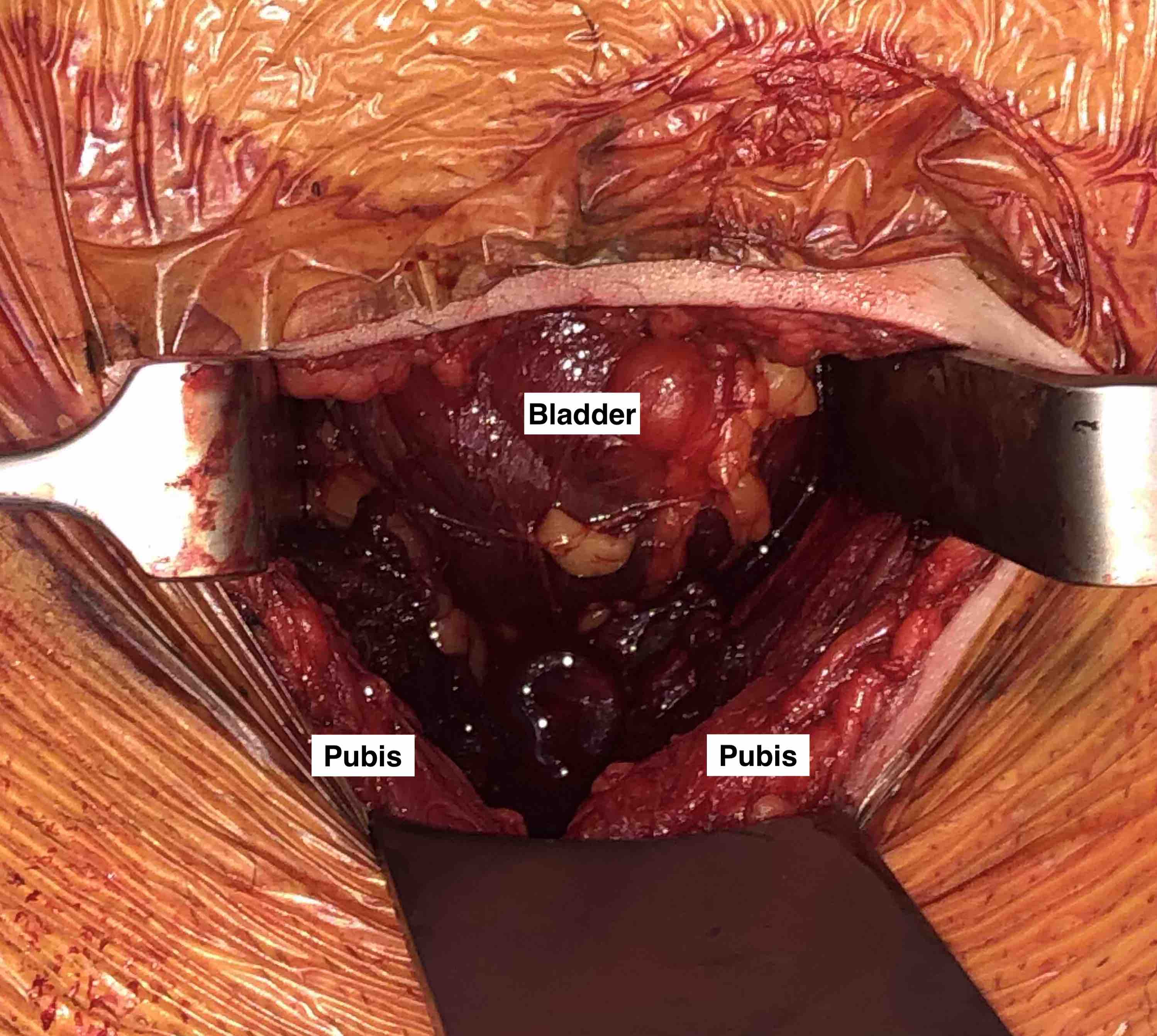 AP Compression | The Bone School